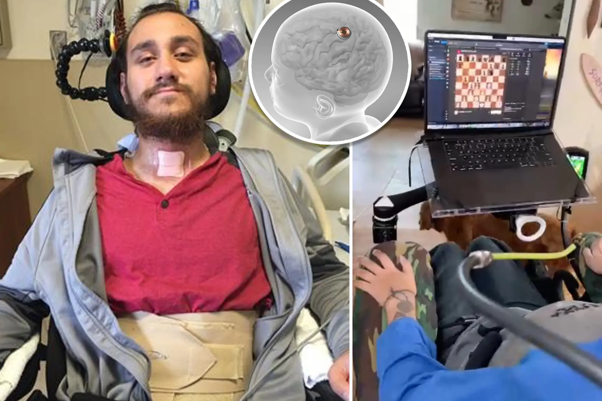Neuralink Reports Malfunction In First Human Brain Implant Real News
